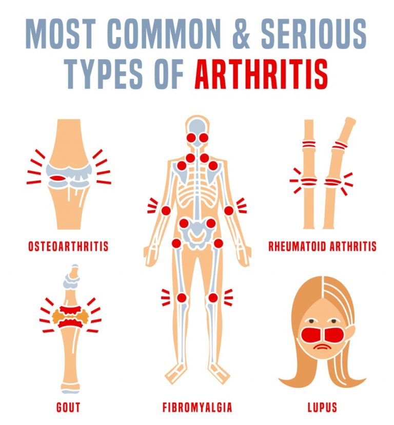 Early Diagnosis and Treatment of Arthritis will help in Immediate Recovery